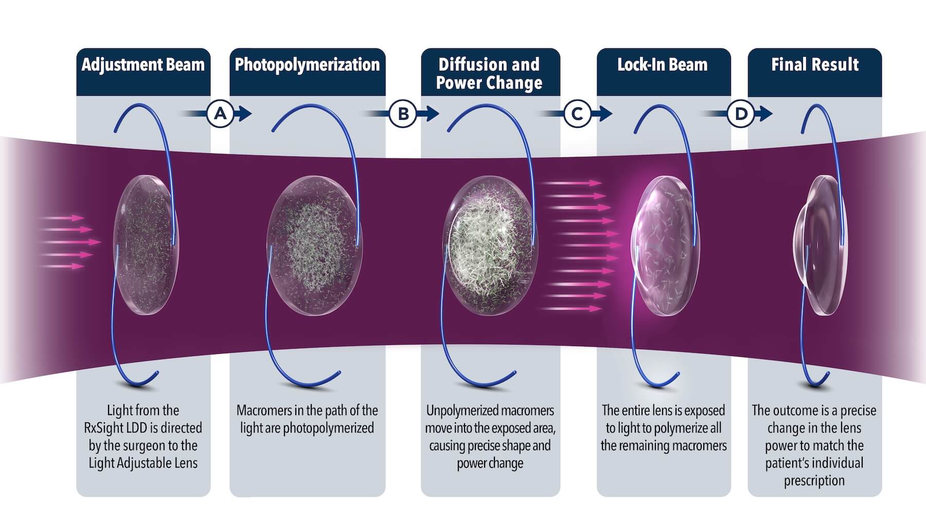 Light Adjustable Lens™ (LAL) Treatment in Frisco | Apex Eye